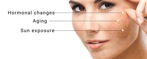 How To Cure Melasma Naturally Best Tips For Stunning Skin