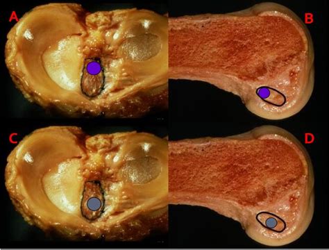 Hydronephrosis Gross