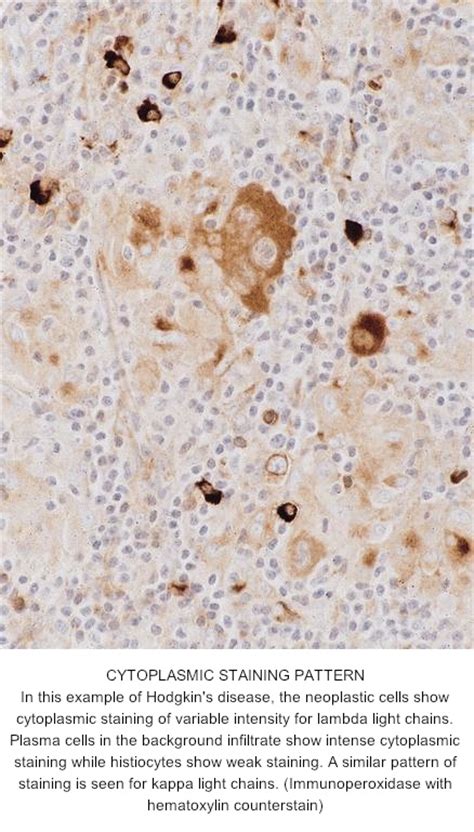 Pathology Outlines Kappa And Lambda Light Chains