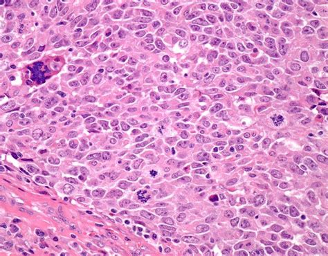 Aiosyns Breast Cancer Algorithm Receives Ce Marking Scientist Live