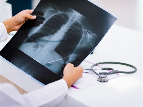 Existen Distintos Grados De Pectus Excavatum