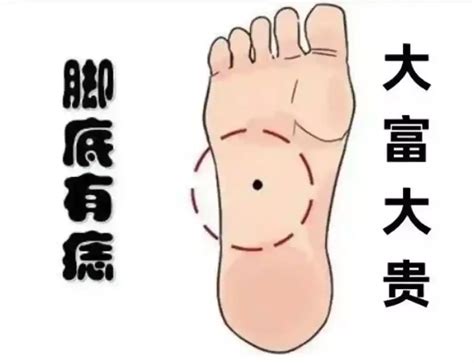 脚底有痣的命运吉凶 脚上长痣的不同含义 黄历网