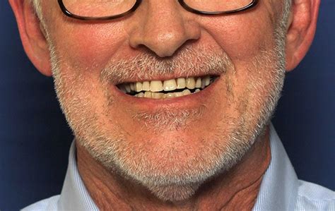 Both Jaws Implant Over Partials Male Dental Implant Center