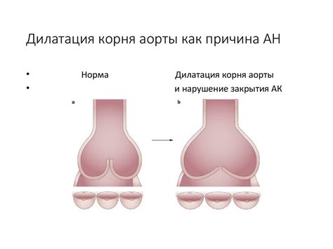 Аортальные пороки сердца презентация онлайн