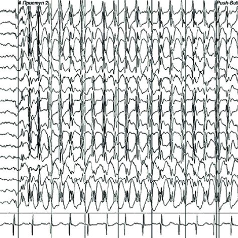 3 Hz Spike Wave Discharges Typical For Idiopathic Genetic Epilepsies