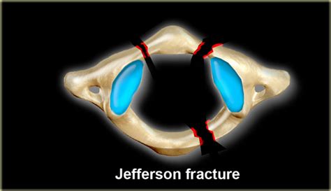 Classification Fractures Atlas Jefferson Fracture Bone