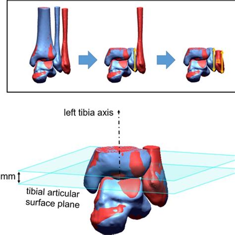 Boxplots Regarding Absolute Values Of Tibiofibular Clear Space Download Scientific Diagram