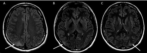 A T2flair Hyperintensity With Associated Focal Cortical Thickening
