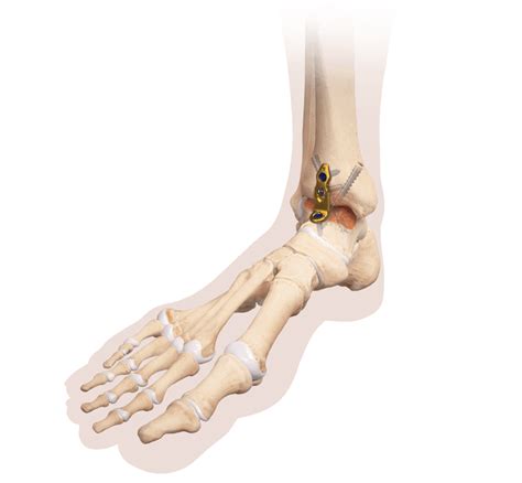 Arthrex Ankle Fusion
