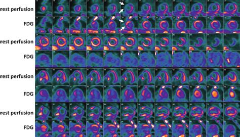 58 Rest 99m Tc Sestamibi Spect Myocardial Perfusion Rest Perfusion Download Scientific Diagram