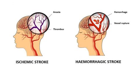 Ischemic Stroke Brain