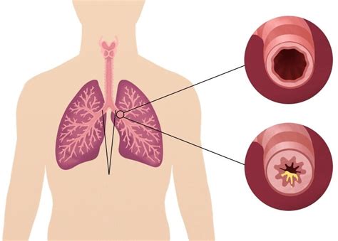 تعرّف على ما يعنيه اختلاف لون البلغم التنخيمة وطريقة علاجه منصة شفاء
