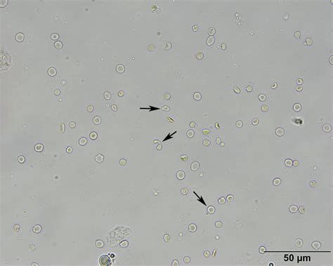 Urine Cells EClinpath