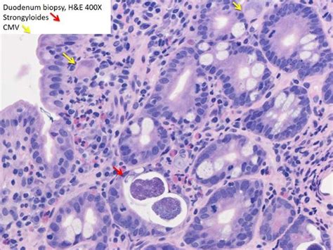 Duodenum Biopsy With Strongyloides Stercoralis And Cmv Inclusions Cmv Download Scientific