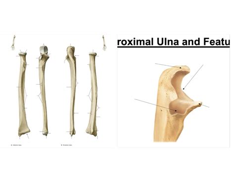 Ulna And Proximal Ulna Quiz