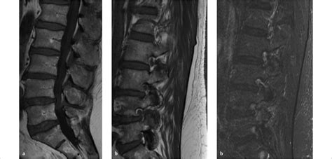 28 Diffusely Abnormal Marrow Signal Within The Vertebrae On Mri Radiology Key