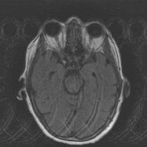 Axial T2 Weighted Sequence Through The Midbrain Download Scientific Diagram