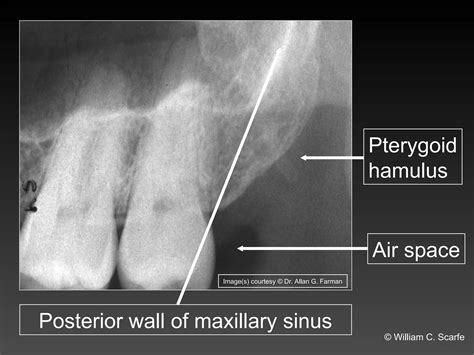 Dental Maxillary And Mandibular Anatomic Radiographic Landmarksppt