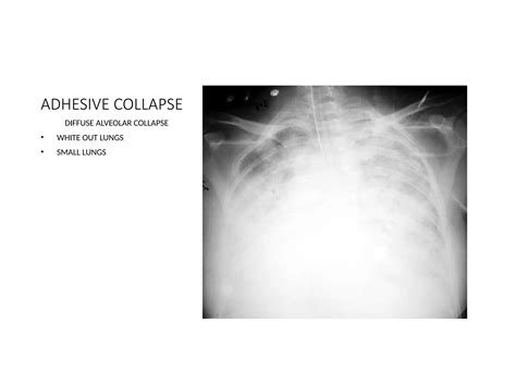 Collapse And Consolidation Pathology And Radiology Pptx