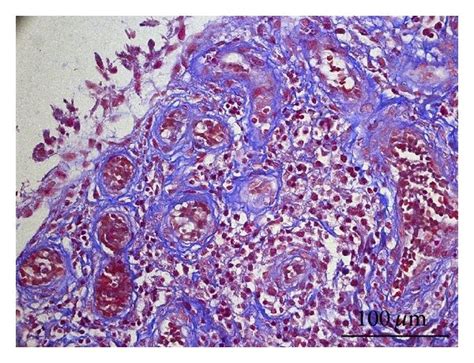 Histopathological Features Of Synovium Of 2 Ra Patients 400x Images
