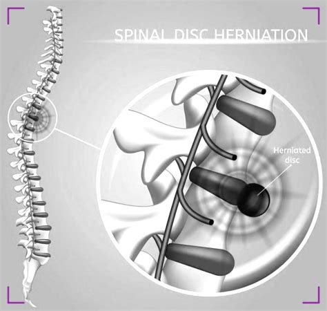 Herniated Disc And Their Impact On Daily Life