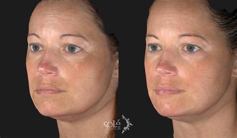 Laser Skin Resurfacing Before And After Pictures Case 30 Tifton