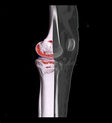 Compare Of Ct Knee Joint 3d Rendering Image Lateral View And Sagittal View Isolated On Black