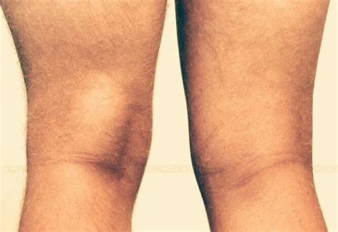 Popliteal Cyst Archives Pt Master Guide