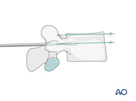 Triangular Osteosynthesis