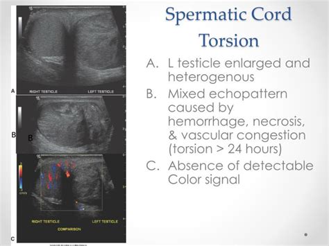 Ppt Scrotal Ultrasound Powerpoint Presentation Id5671926
