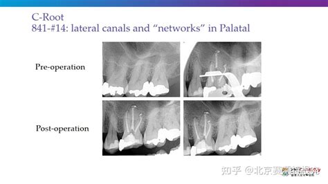 张成飞教授《生物陶瓷根管充填糊剂，根管治疗变革的推动者》报告 知乎