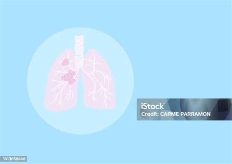폐암 종양이있는 폐 폐암에 대한 스톡 벡터 아트 및 기타 이미지 폐암 폐 생물학 Istock