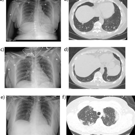 1a 1b And 1c From Left To Right Clockwise Admission Cxr Shows Low Download Scientific