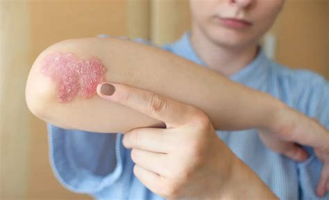 Is Psoriasis Permanently Curable