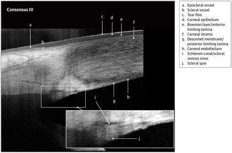 Panel Proposes Standardized Nomenclature For As Oct Findings