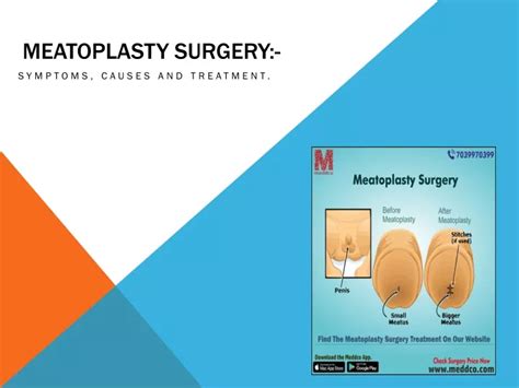 Ppt Meatoplasty Surgery Powerpoint Presentation Free Download Id
