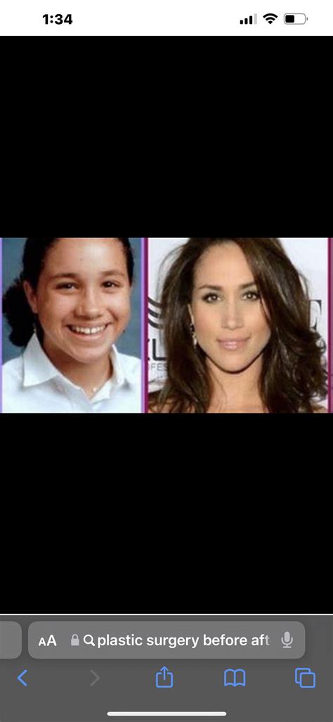 Plastic Surgery Photos Celebrities Celebs Celebrity Famous People