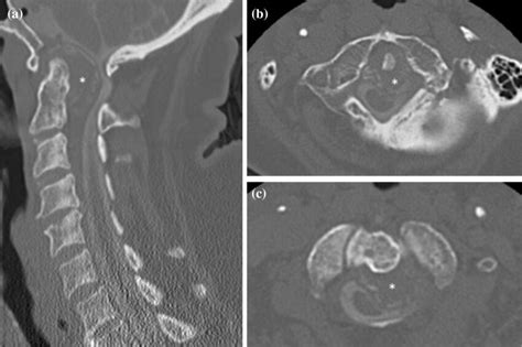 Case 1 Preoperative Ct Myelography Revealed A Sizeable Retro Odontoid Download Scientific