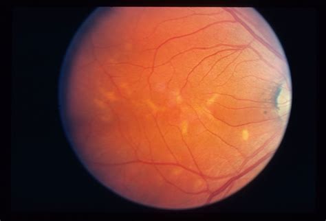 Pattern Dystrophy Retina Image Bank