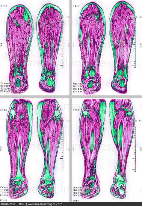 Stock Image 1105705 01a8cmap Bsip Search Medical And Scientific
