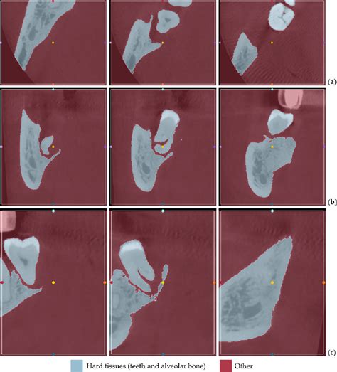 Table 1 From The Role Of Cone Beam Computed Tomography In Periodontology From 3d Models Of