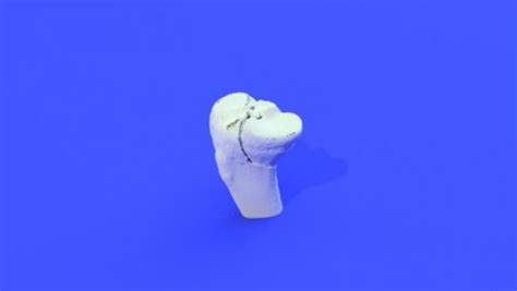 Tibial Plateau Fracture Extremity Lower Leg Embodi3D