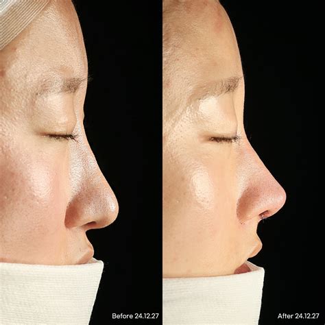 Dr 권유진의 성형이야기 수술후 3개월 60대 작년 뉴진성형외과 개원 후 얼마지나지 않아 따님과 함께 오셨었어요