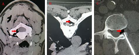 Ct Guided Prf Combined With Ozone Injection On Zap Jpr