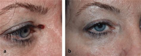 Medial Canthal Eyelid Reconstruction Ento Key
