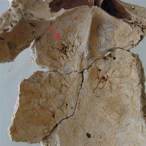 Endocranial View Of Hyperostosis Frontalis Interna Arrow In A Download High Resolution