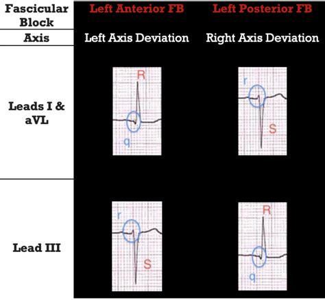 Fascicular Block Ecg Criteria At Ashley Moskowitz Blog