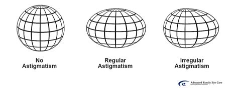 Astigmatism Qanda Symptoms Causes Treatment