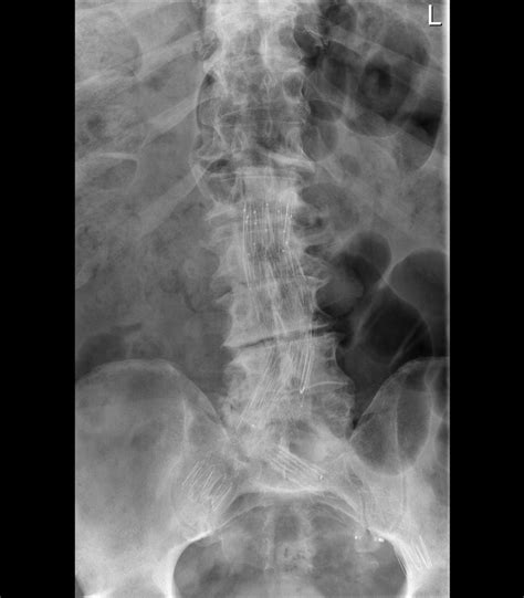 Evar Radiology At St Vincents University Hospital