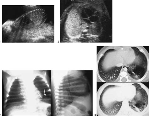 38 Congentical Cystic Adenomatoid Malformation Radiology Key
